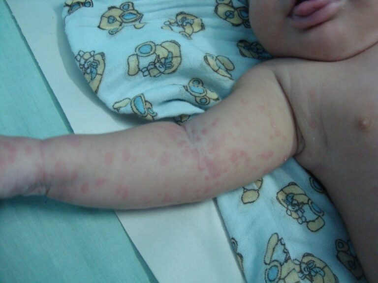 Sífilis se ensaña con recién nacidos del sur de Honduras - Proceso Digital